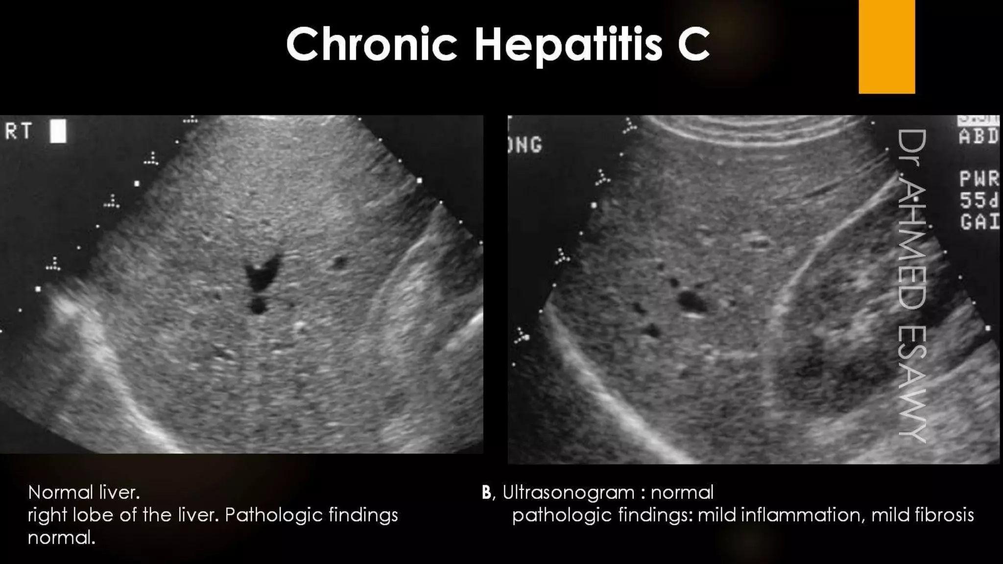 Ultrasound diffuse liver disease all things fibrosis,cirrhosis,us scoring,ce lrad,fibroscan ...