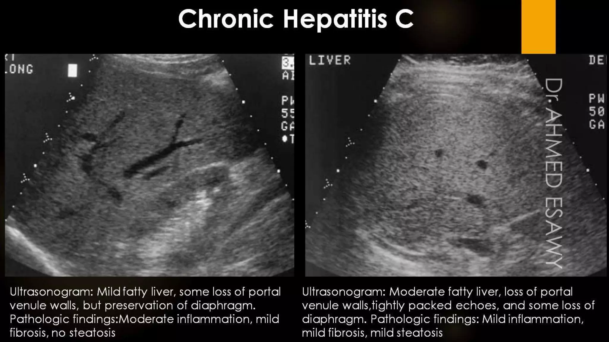 Ultrasound diffuse liver disease all things fibrosis,cirrhosis,us ...