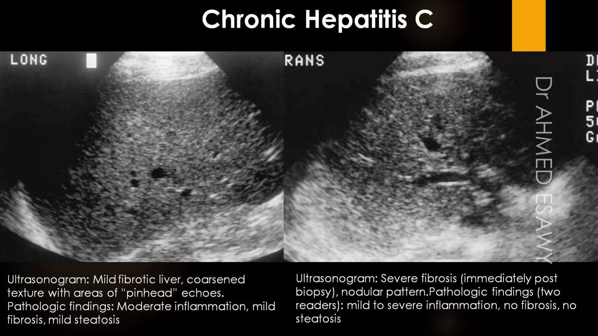 Ultrasound diffuse liver disease all things fibrosis,cirrhosis,us ...