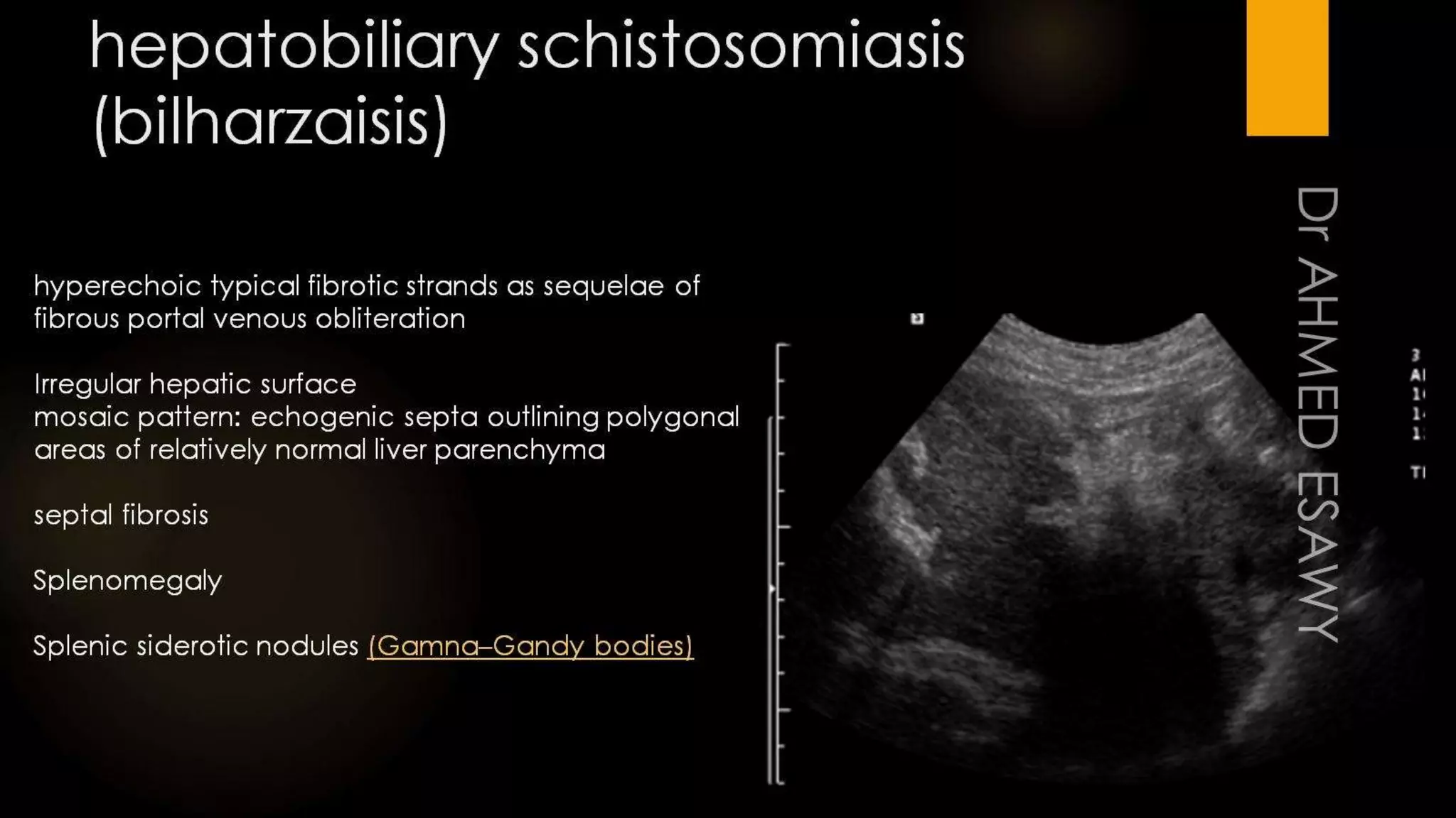 Ultrasound diffuse liver disease all things fibrosis,cirrhosis,us ...