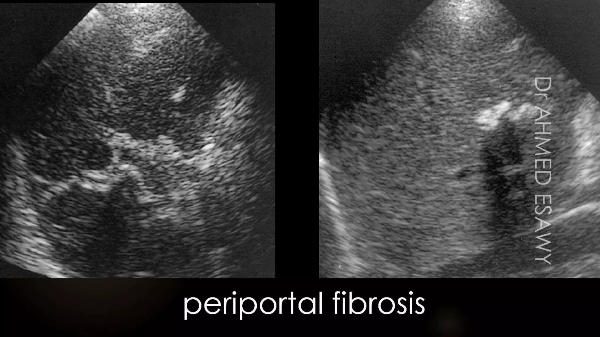 Ultrasound diffuse liver disease all things fibrosis,cirrhosis,us ...