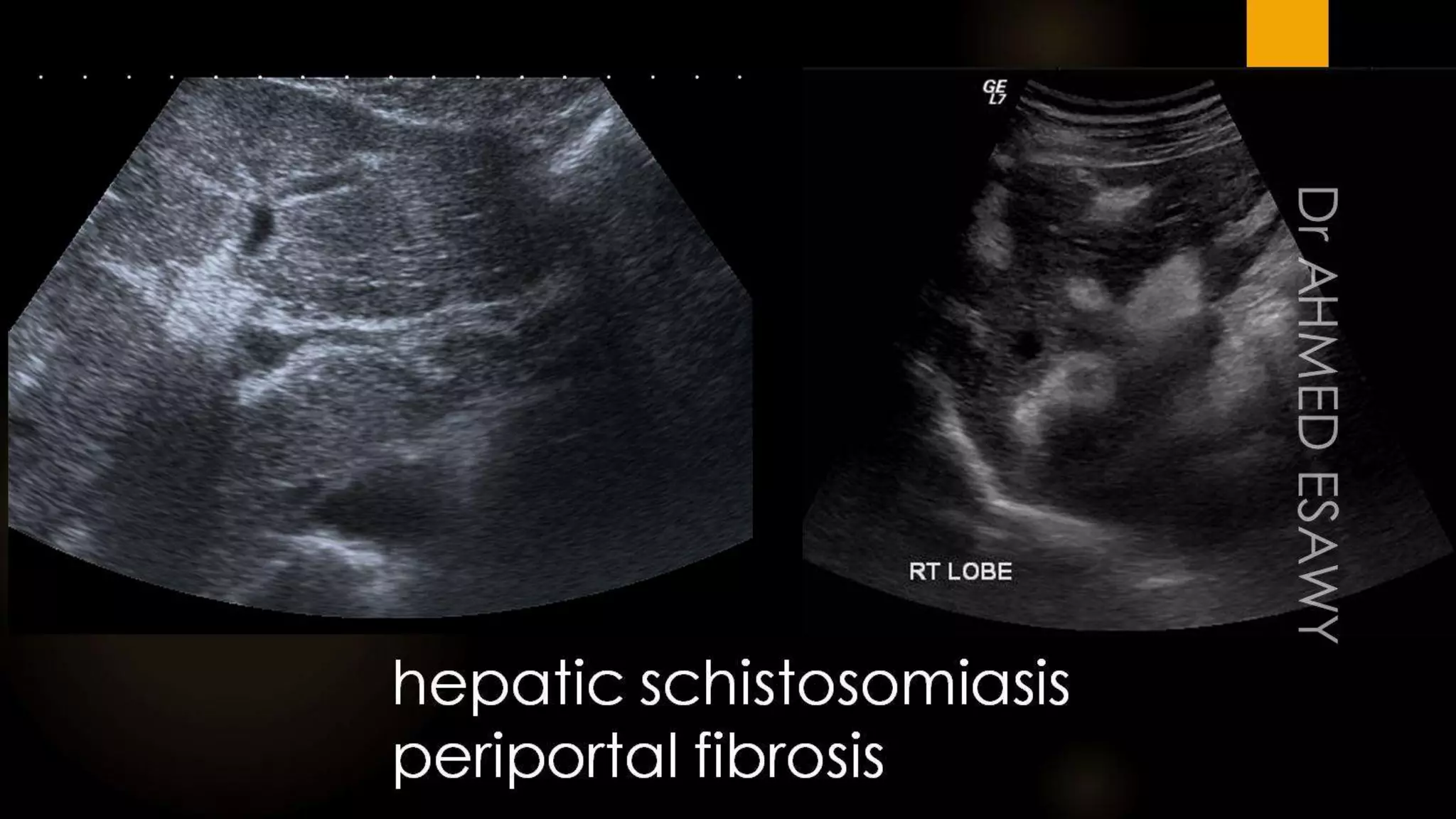 Ultrasound diffuse liver disease all things fibrosis,cirrhosis,us ...