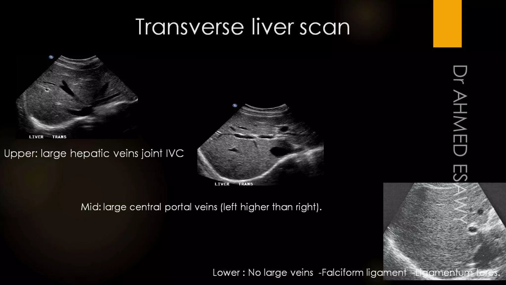 Ultrasound diffuse liver disease all things fibrosis,cirrhosis,us ...