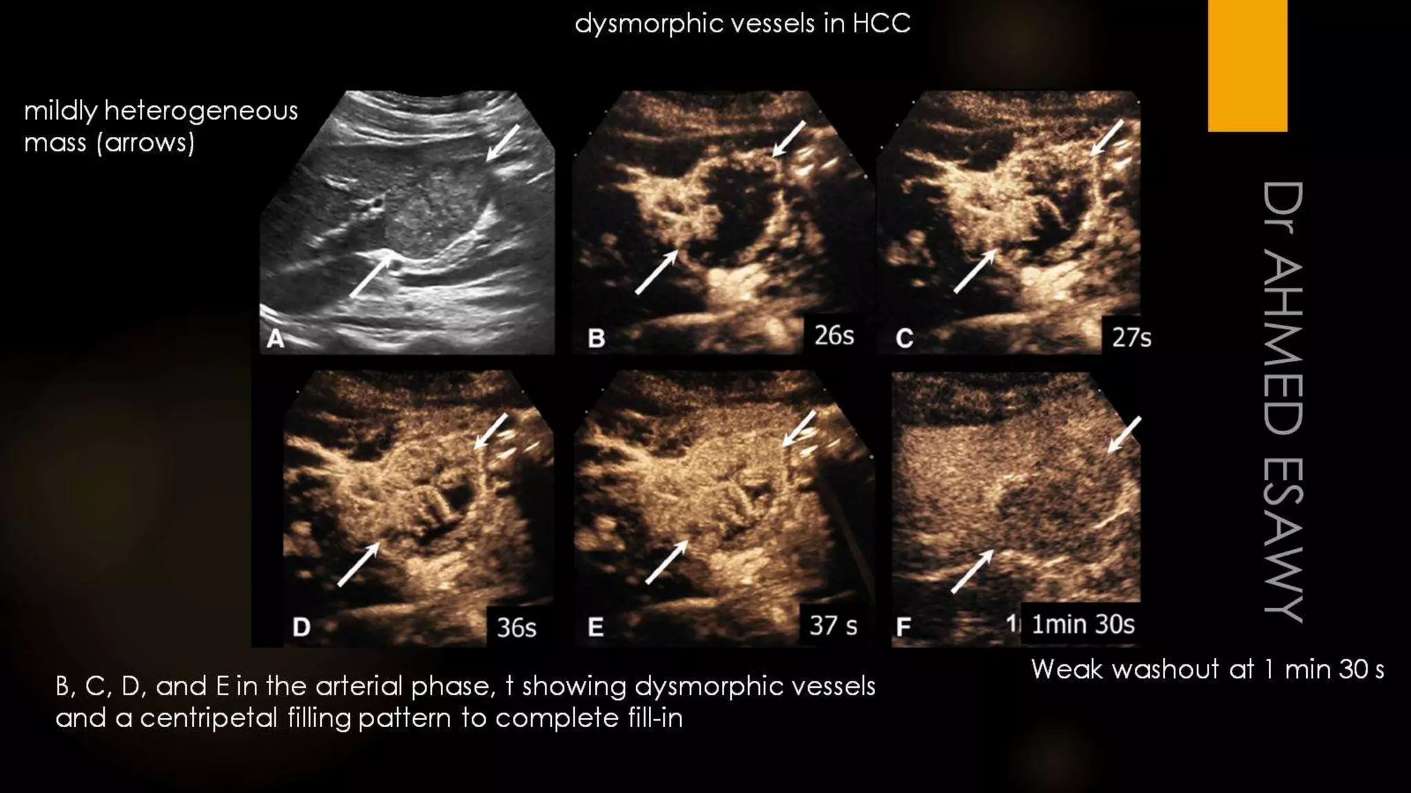 Ultrasound diffuse liver disease all things fibrosis,cirrhosis,us ...