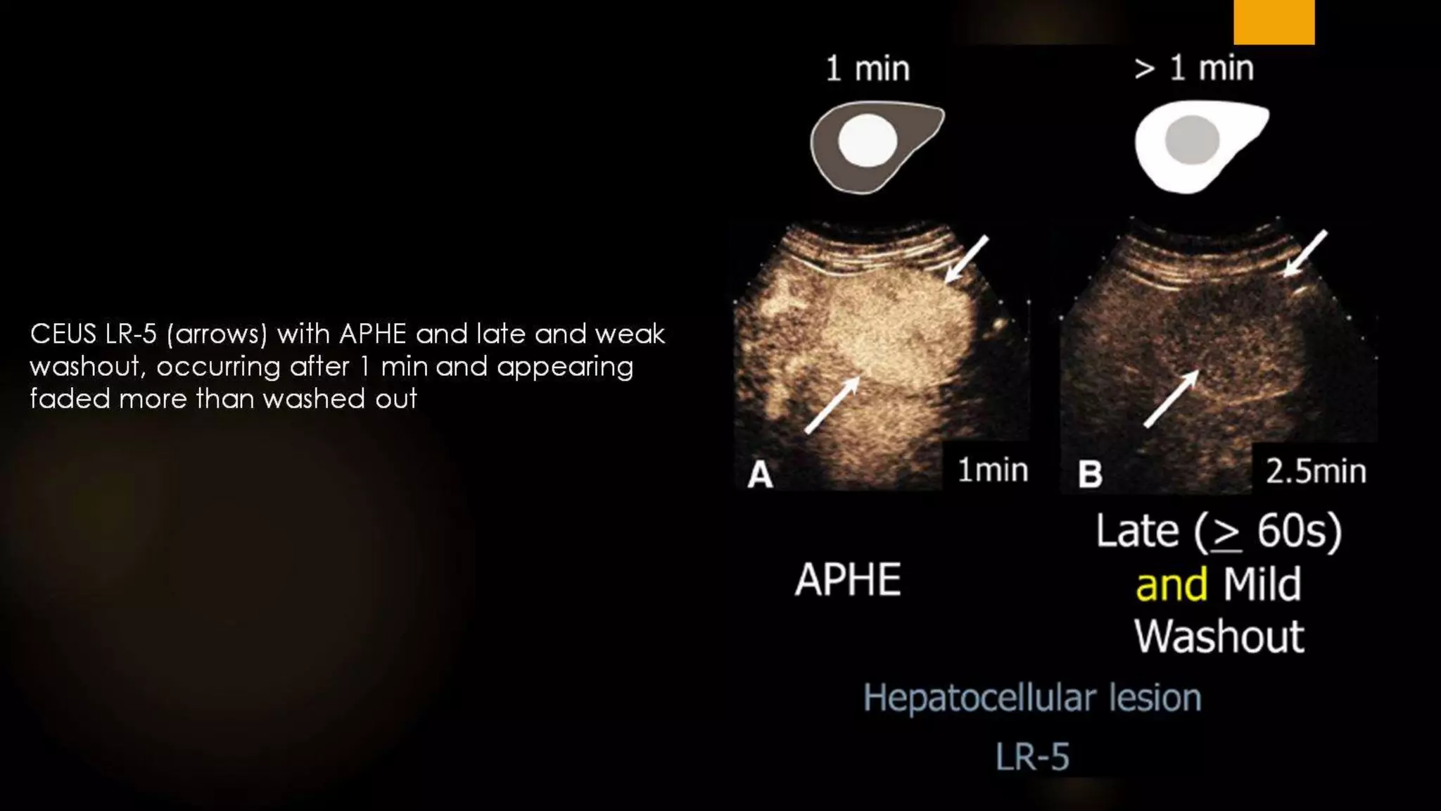 Ultrasound diffuse liver disease all things fibrosis,cirrhosis,us ...