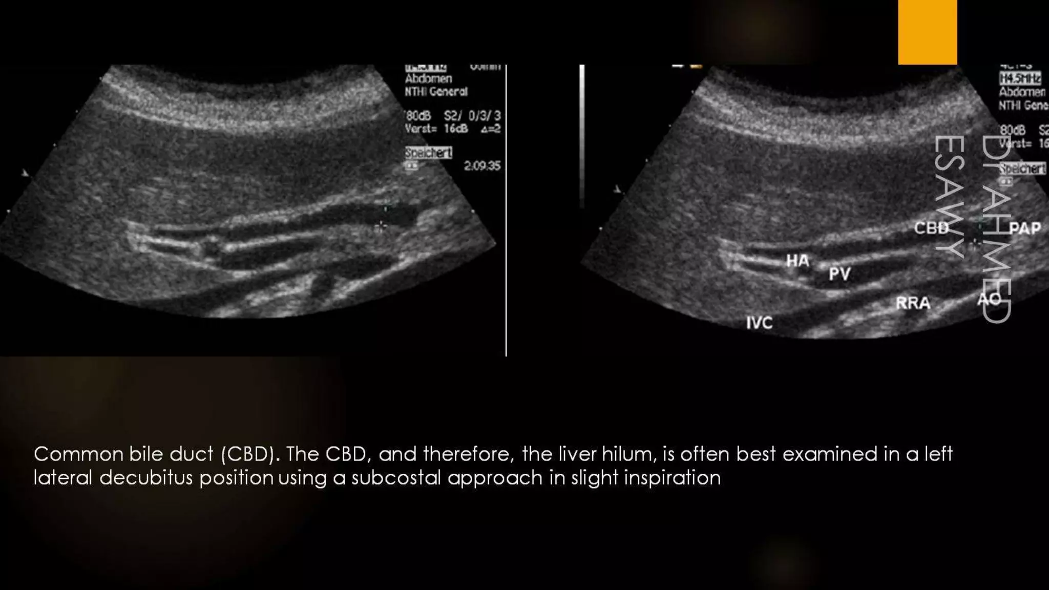 Ultrasound diffuse liver disease all things fibrosis,cirrhosis,us ...