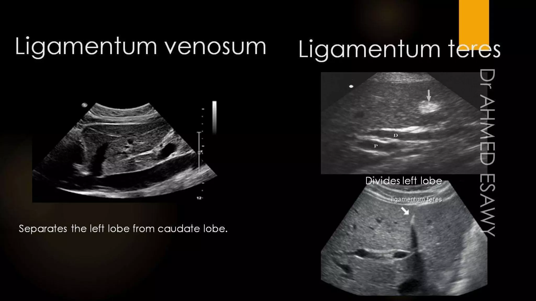 Ultrasound diffuse liver disease all things fibrosis,cirrhosis,us ...