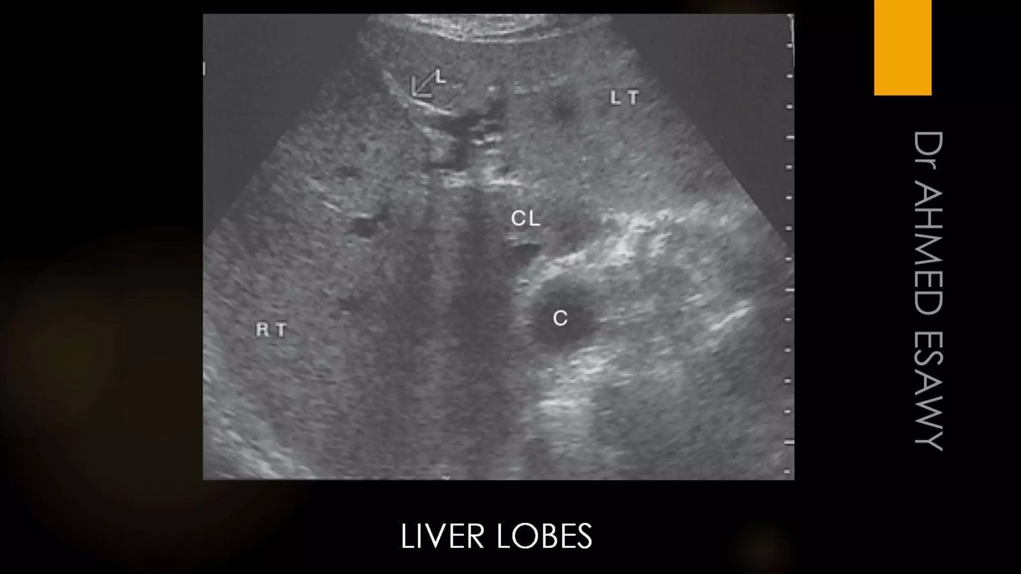 Ultrasound diffuse liver disease all things fibrosis,cirrhosis,us ...