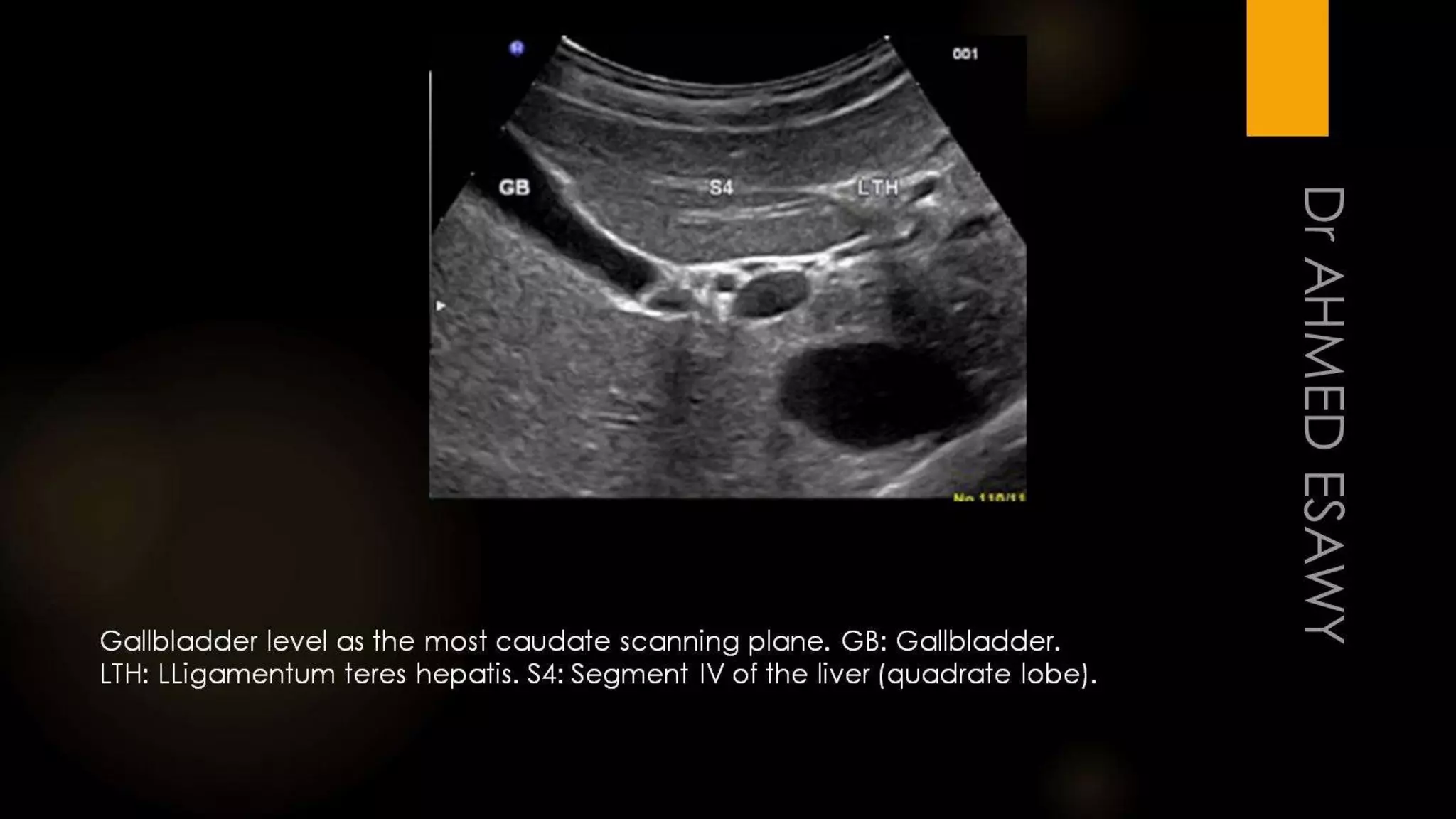 Ultrasound diffuse liver disease all things fibrosis,cirrhosis,us ...
