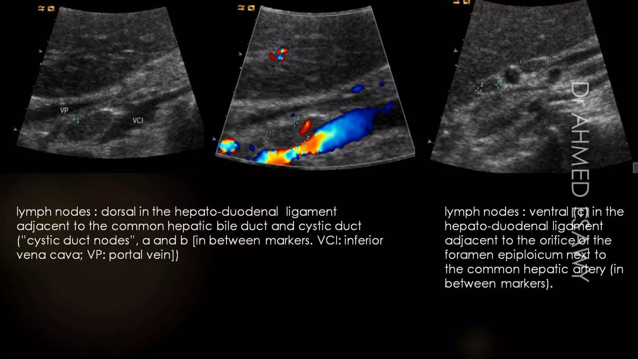 Ultrasound diffuse liver disease all things fibrosis,cirrhosis,us ...