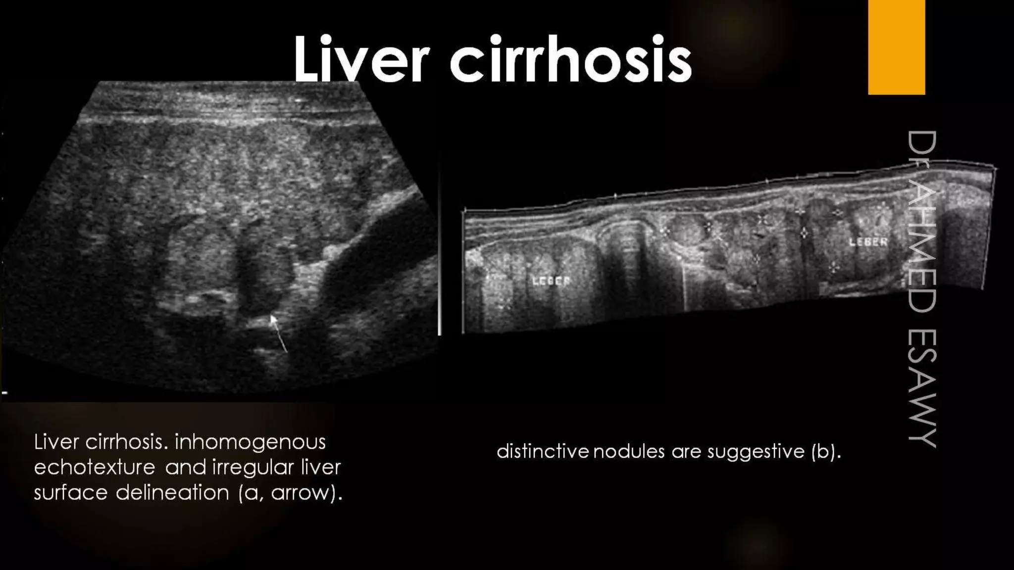 Ultrasound diffuse liver disease all things fibrosis,cirrhosis,us ...