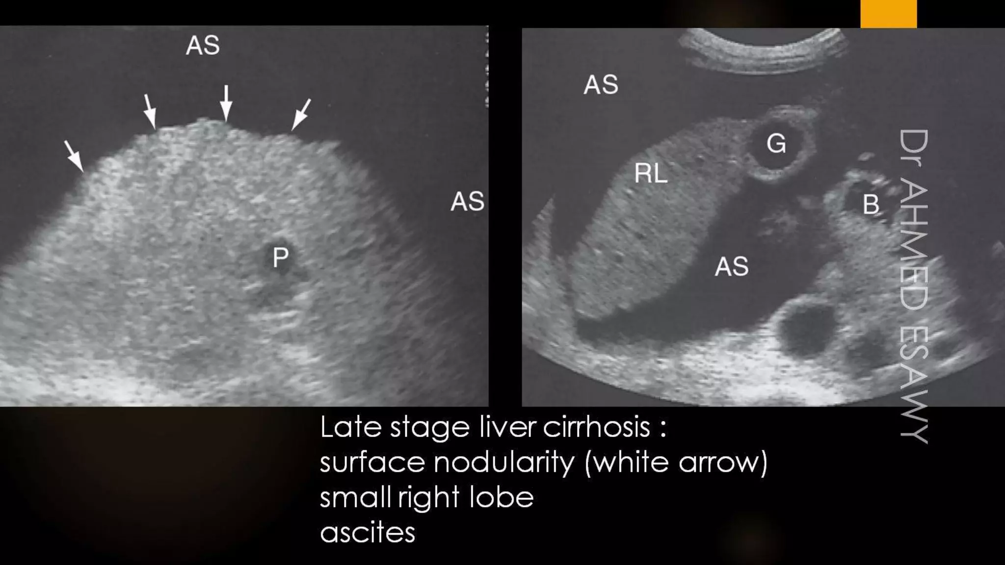 Ultrasound diffuse liver disease all things fibrosis,cirrhosis,us ...