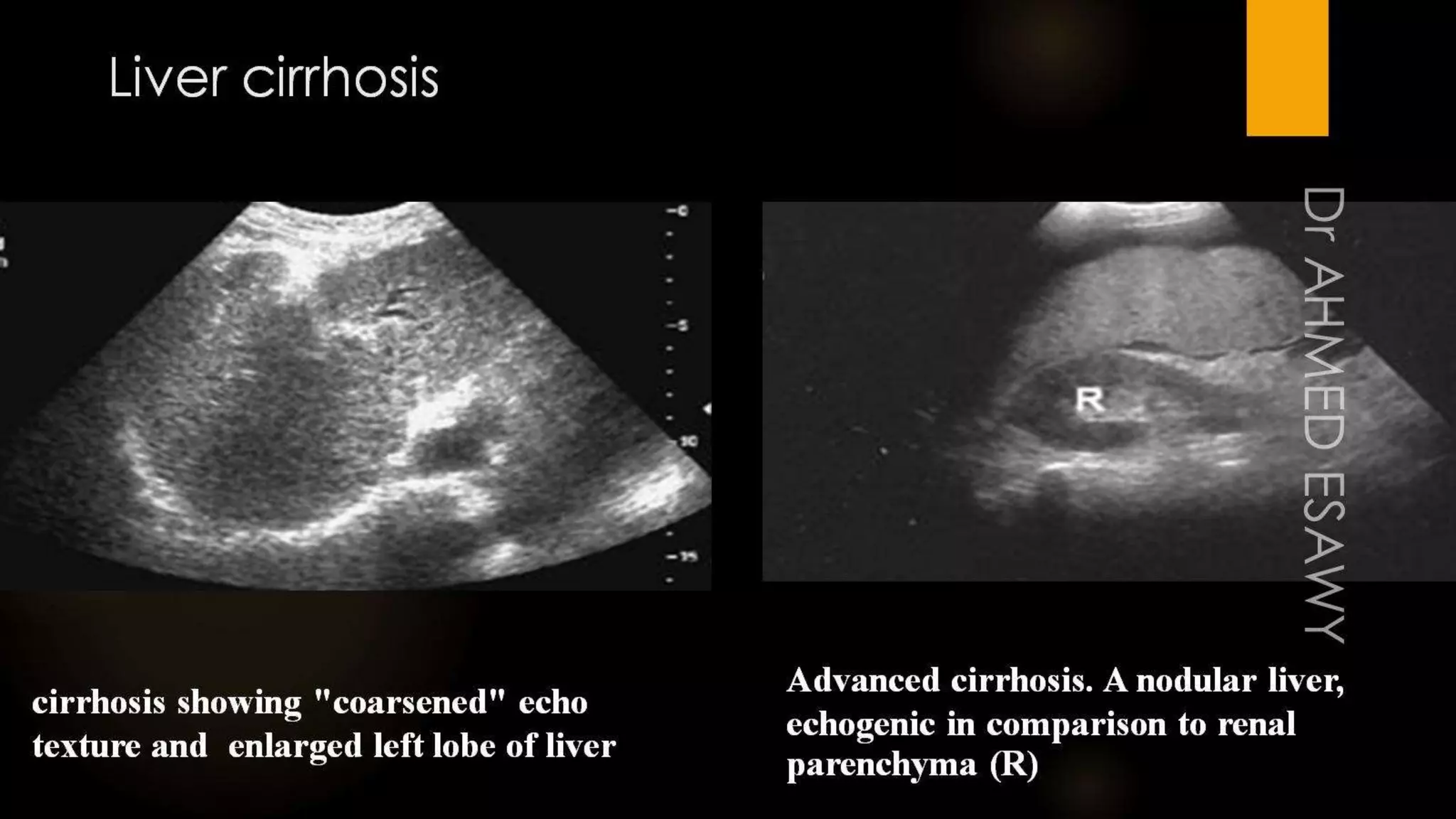 Ultrasound diffuse liver disease all things fibrosis,cirrhosis,us ...