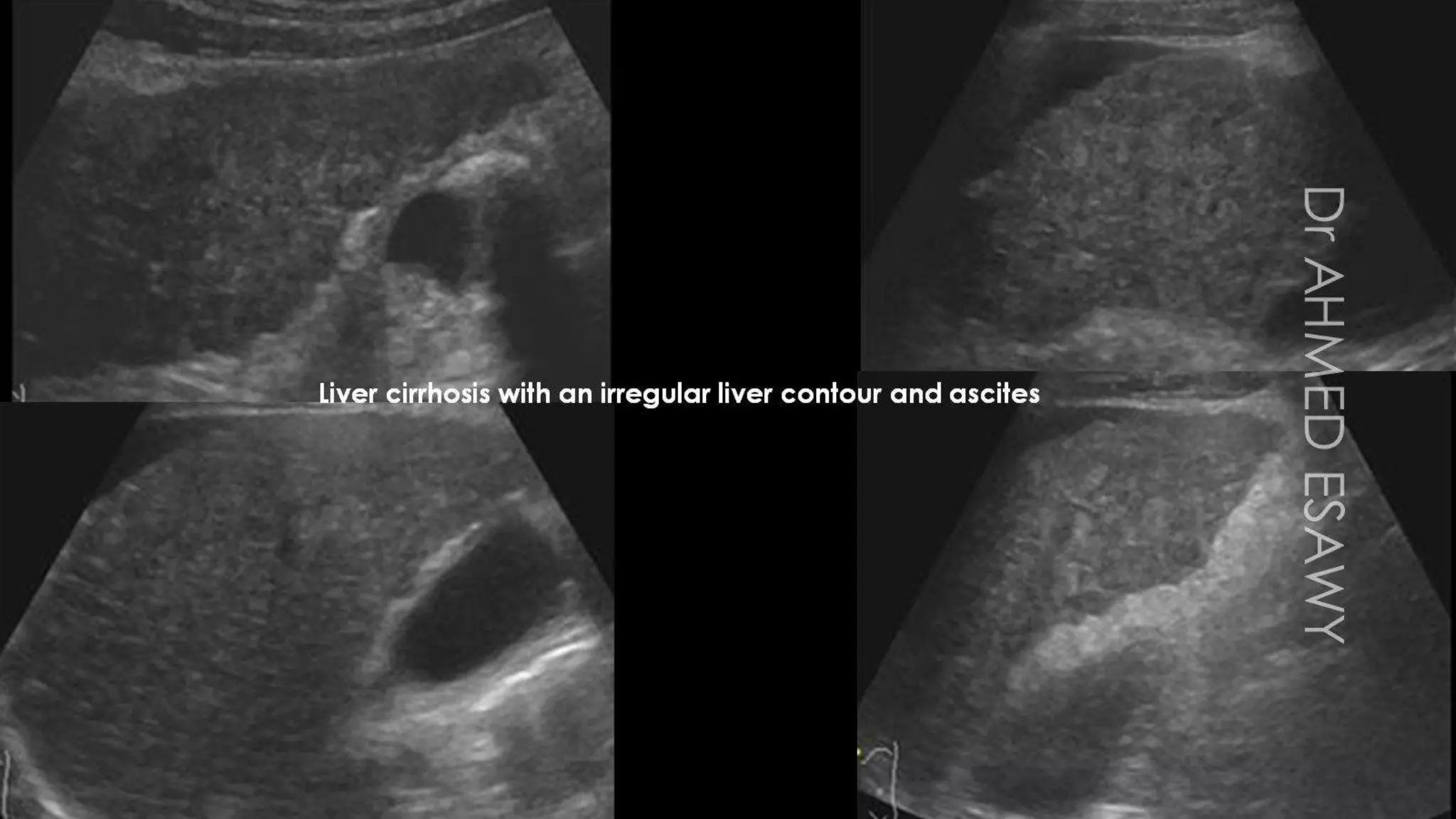Ultrasound diffuse liver disease all things fibrosis,cirrhosis,us ...