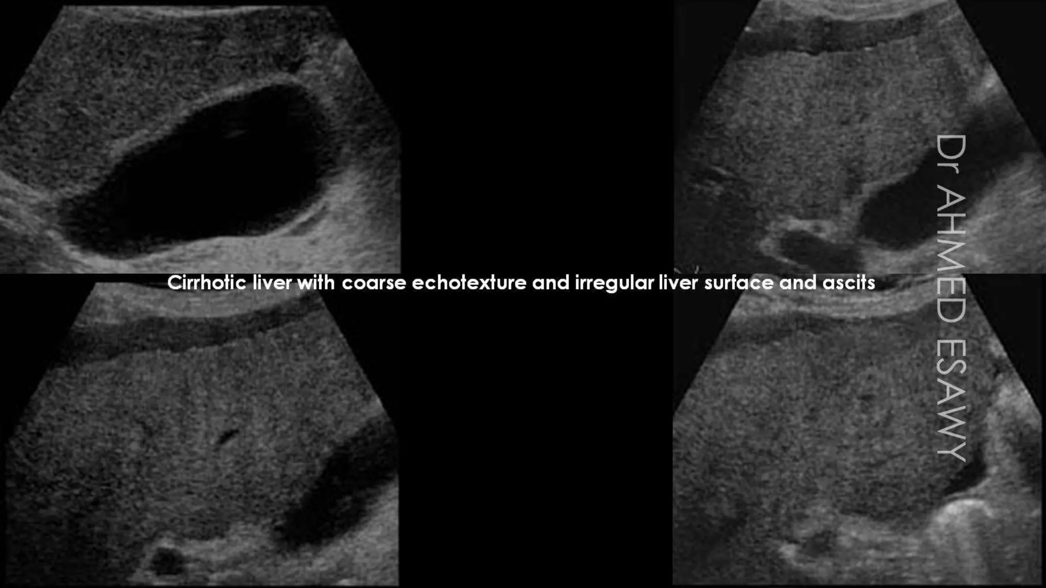 Ultrasound diffuse liver disease all things fibrosis,cirrhosis,us ...
