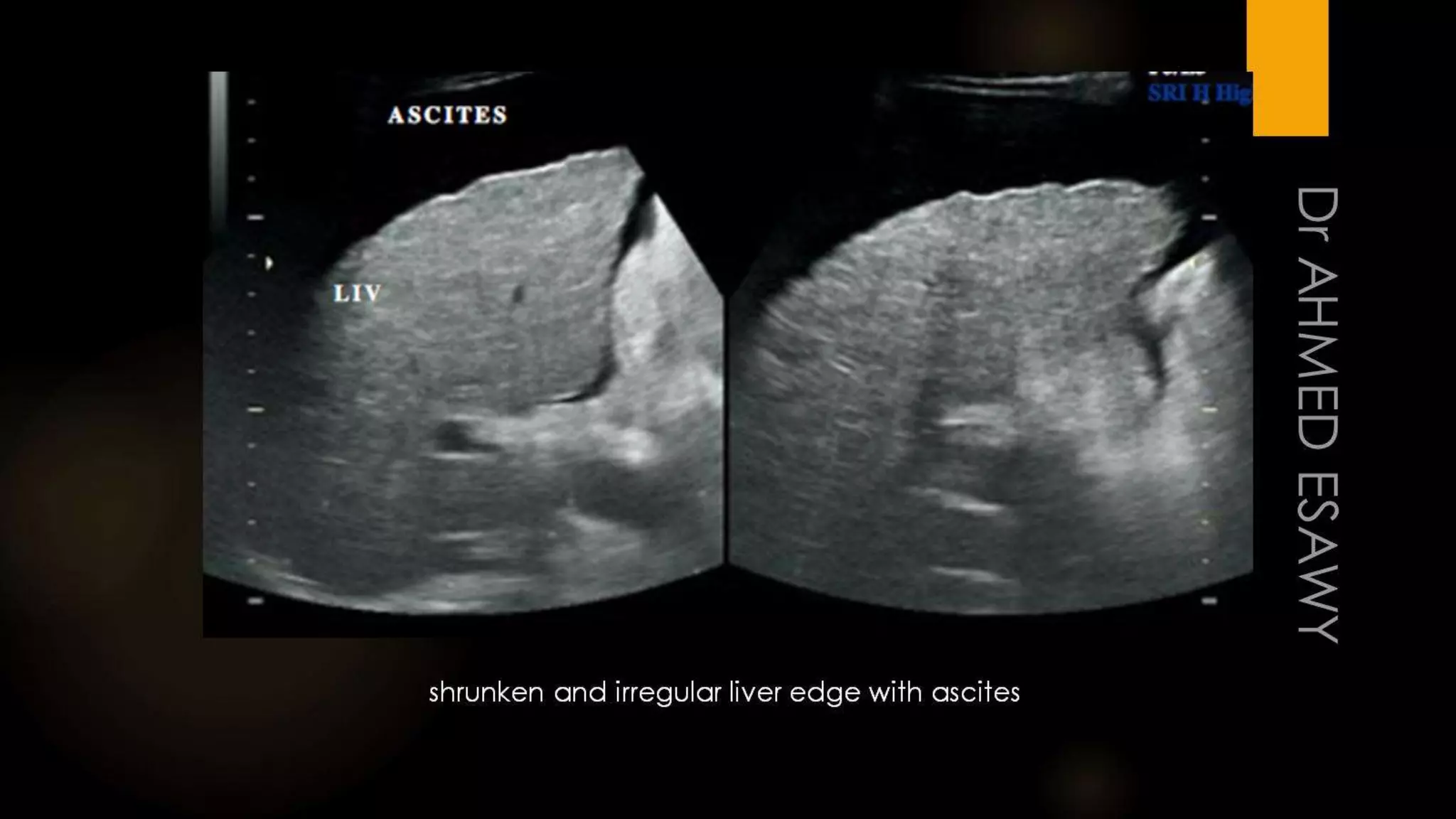 Ultrasound diffuse liver disease all things fibrosis,cirrhosis,us ...