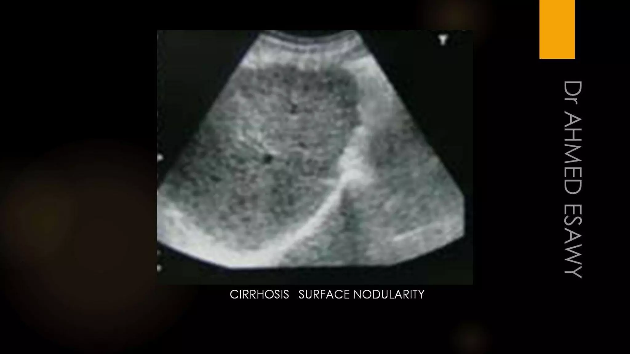 Ultrasound diffuse liver disease all things fibrosis,cirrhosis,us ...