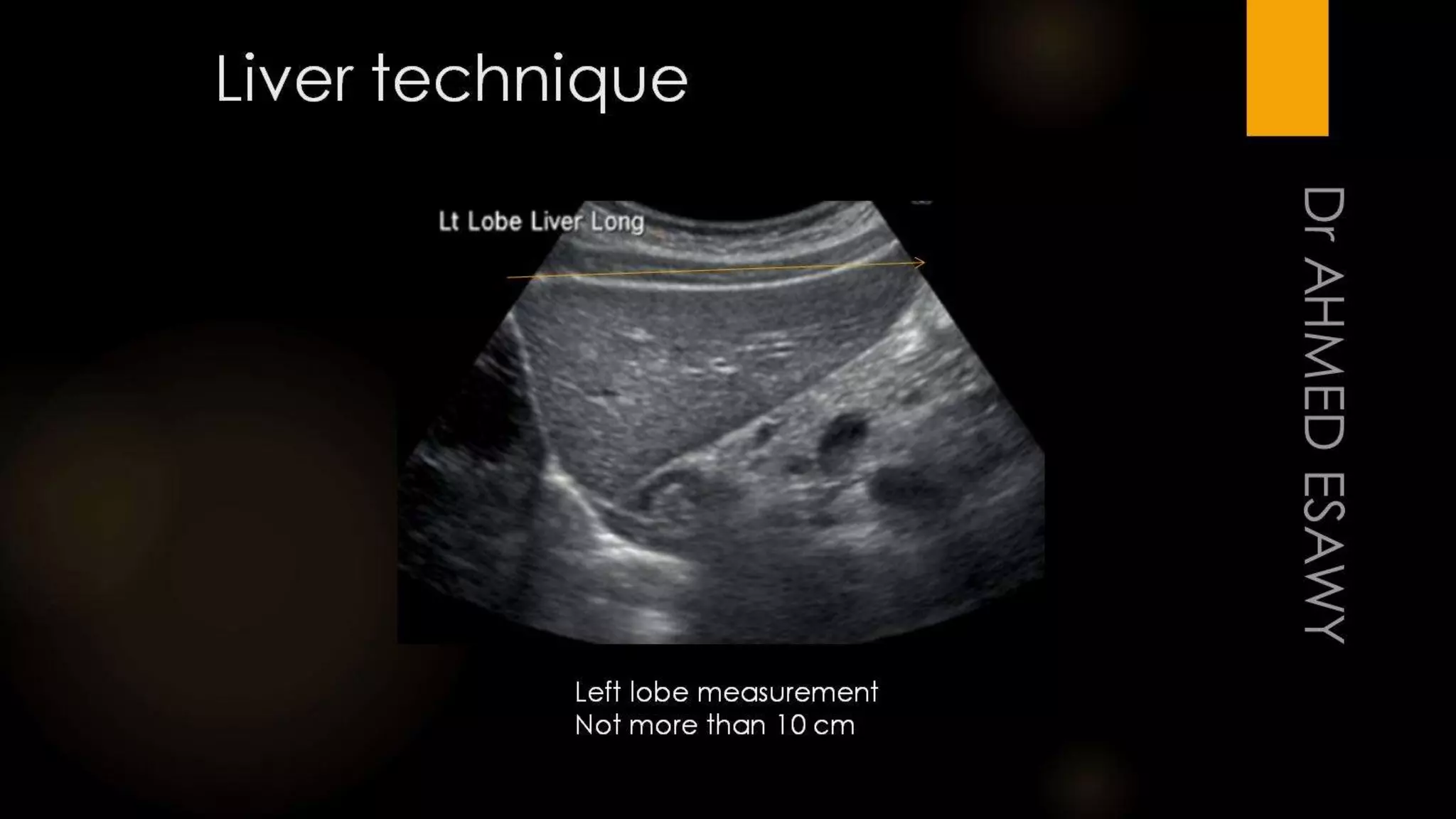 Ultrasound diffuse liver disease all things fibrosis,cirrhosis,us scoring,ce lrad,fibroscan ...