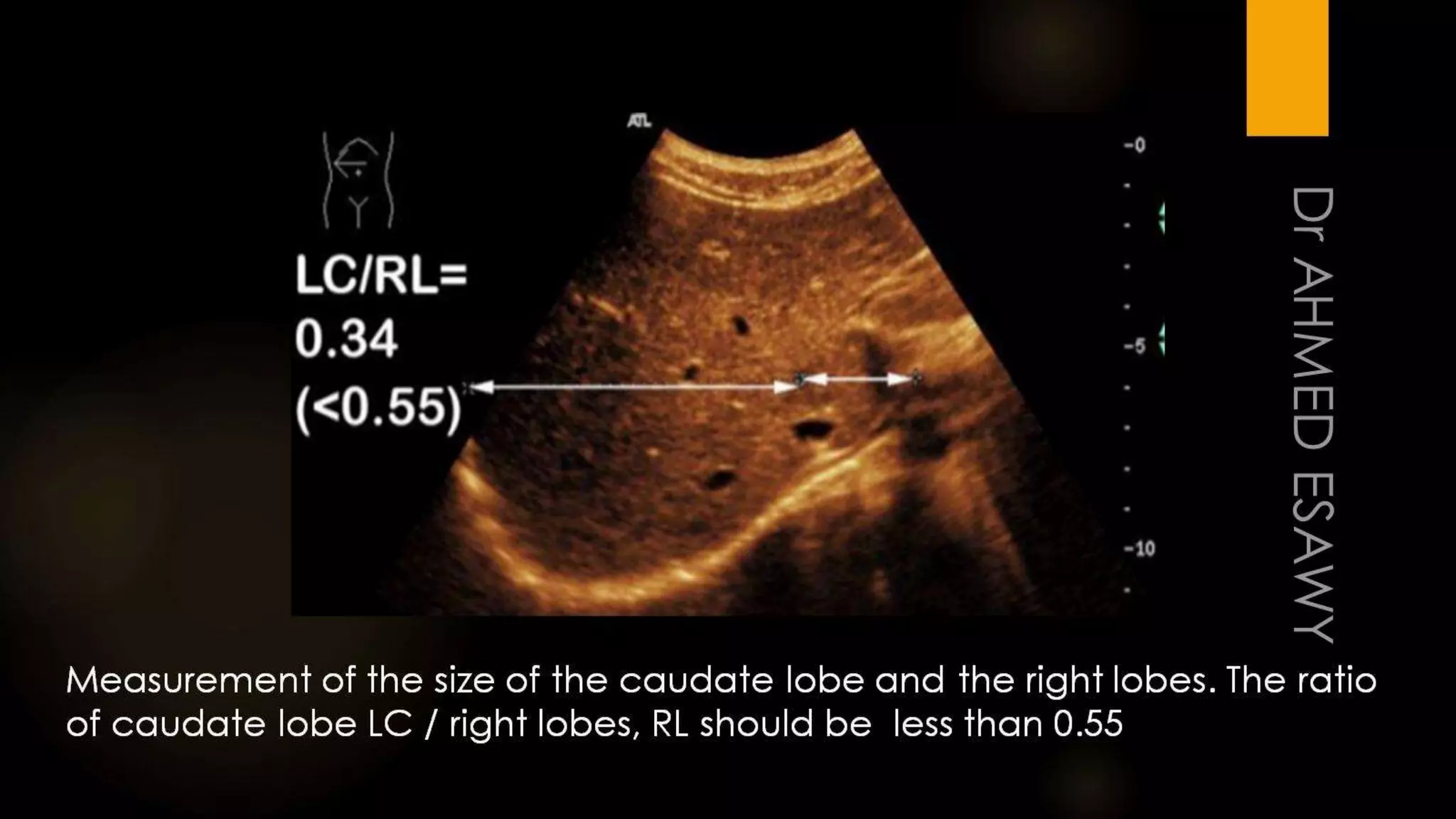 Ultrasound diffuse liver disease all things fibrosis,cirrhosis,us ...