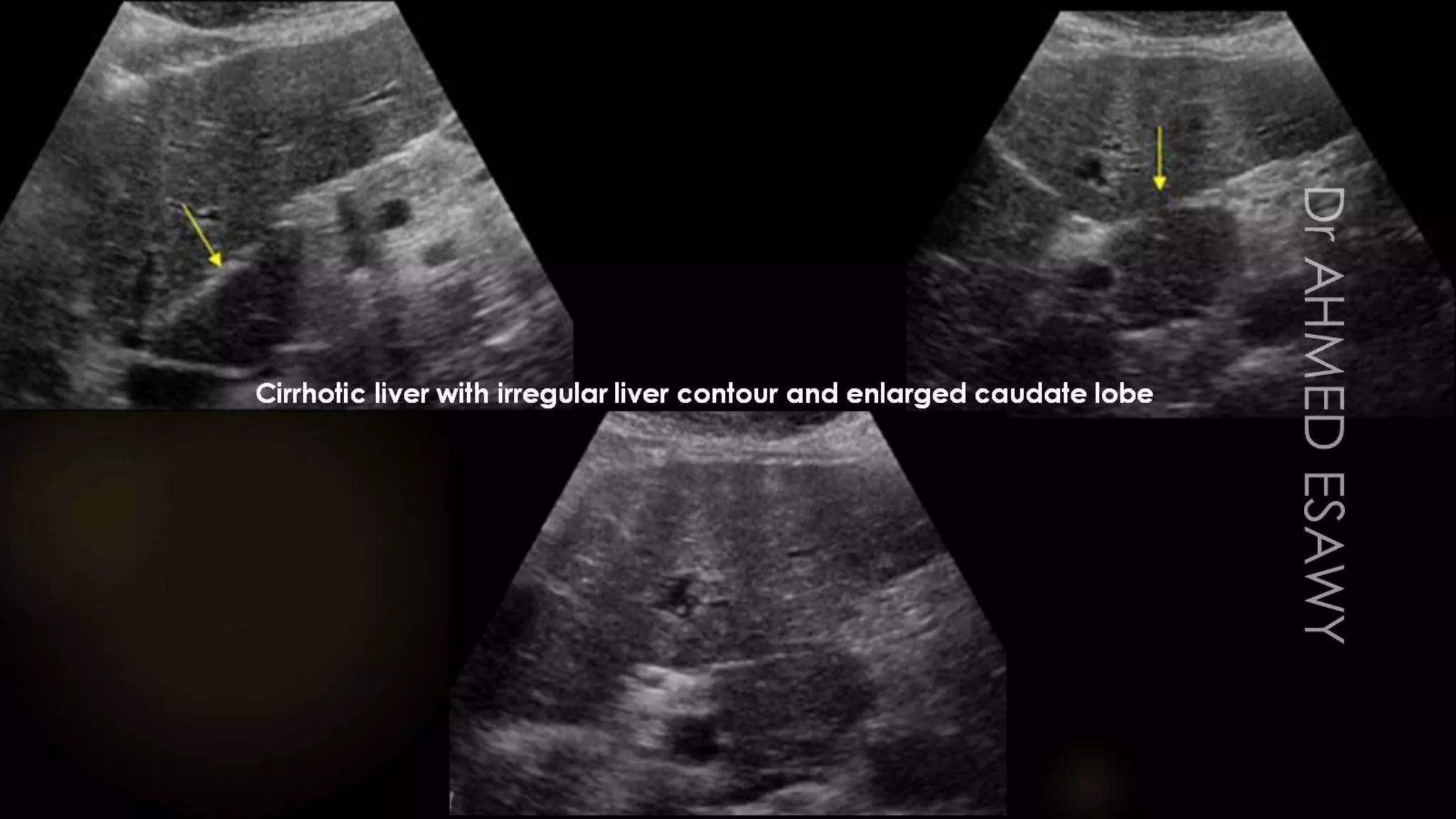 Ultrasound diffuse liver disease all things fibrosis,cirrhosis,us ...