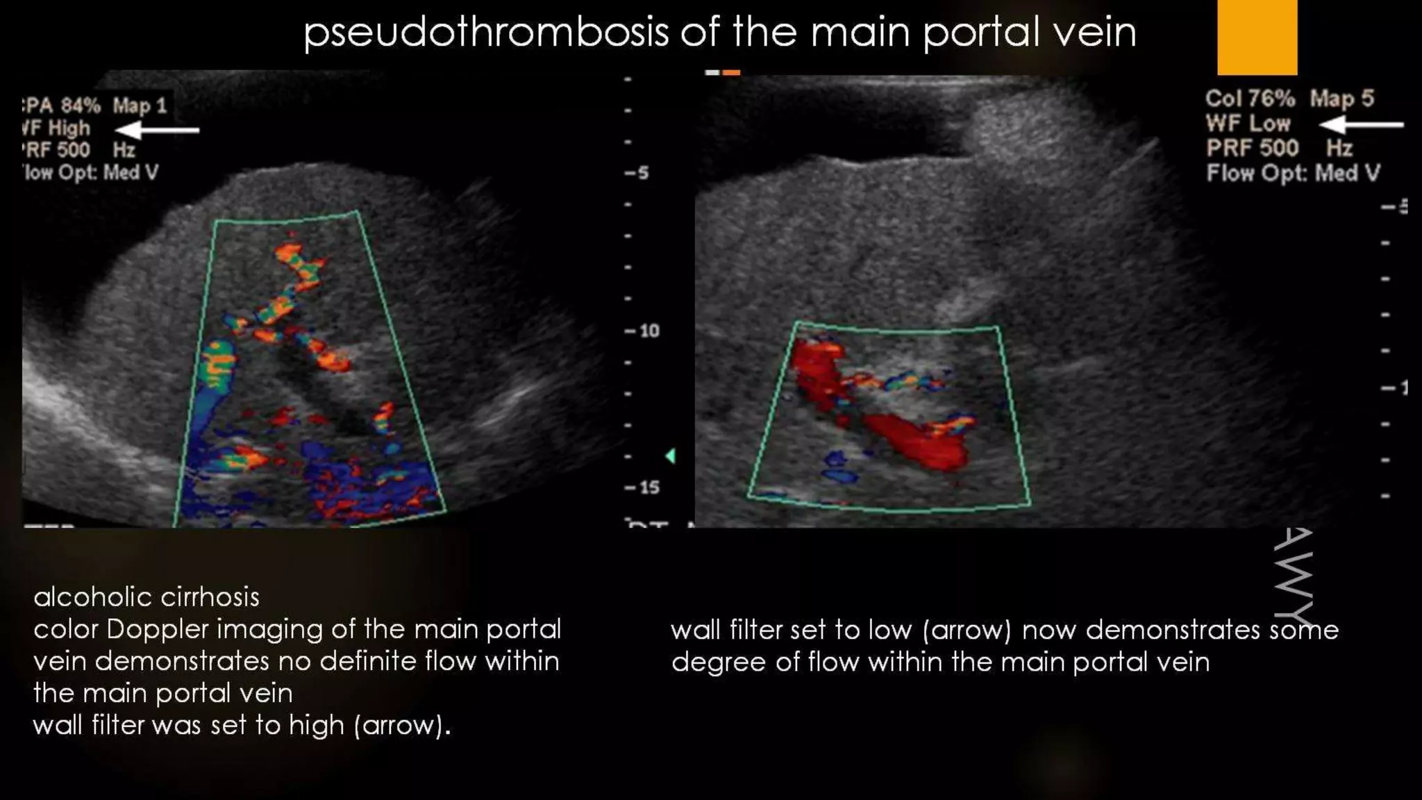 Ultrasound diffuse liver disease all things fibrosis,cirrhosis,us ...