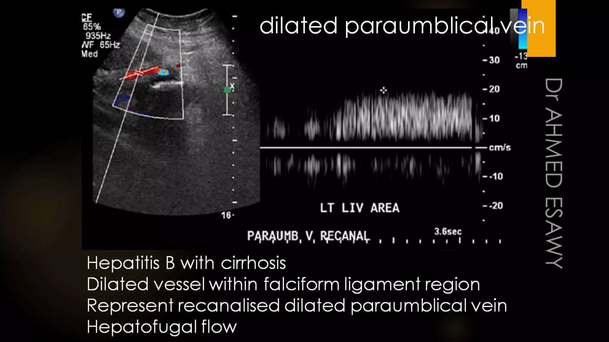 Ultrasound diffuse liver disease all things fibrosis,cirrhosis,us ...