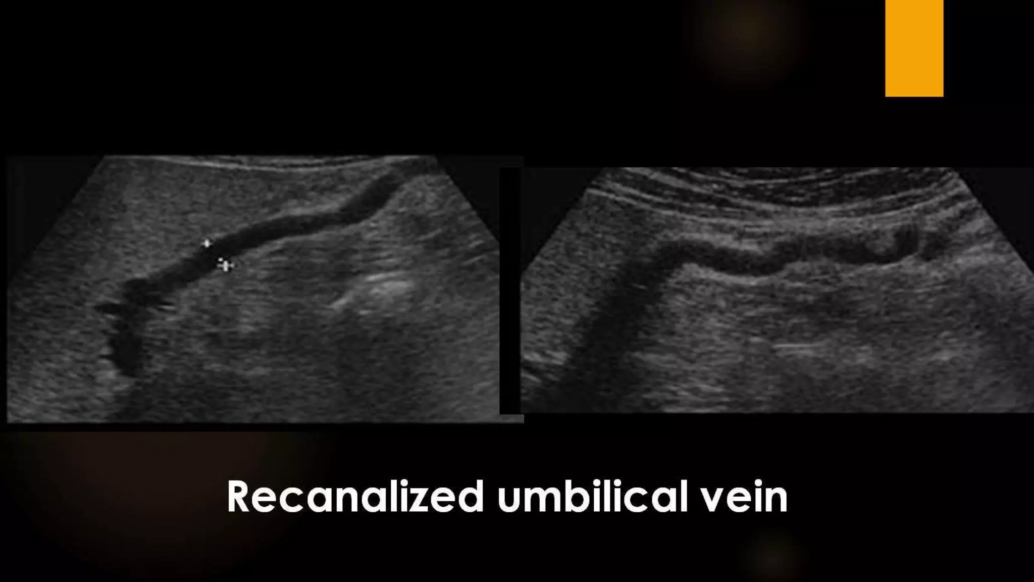 Ultrasound diffuse liver disease all things fibrosis,cirrhosis,us ...