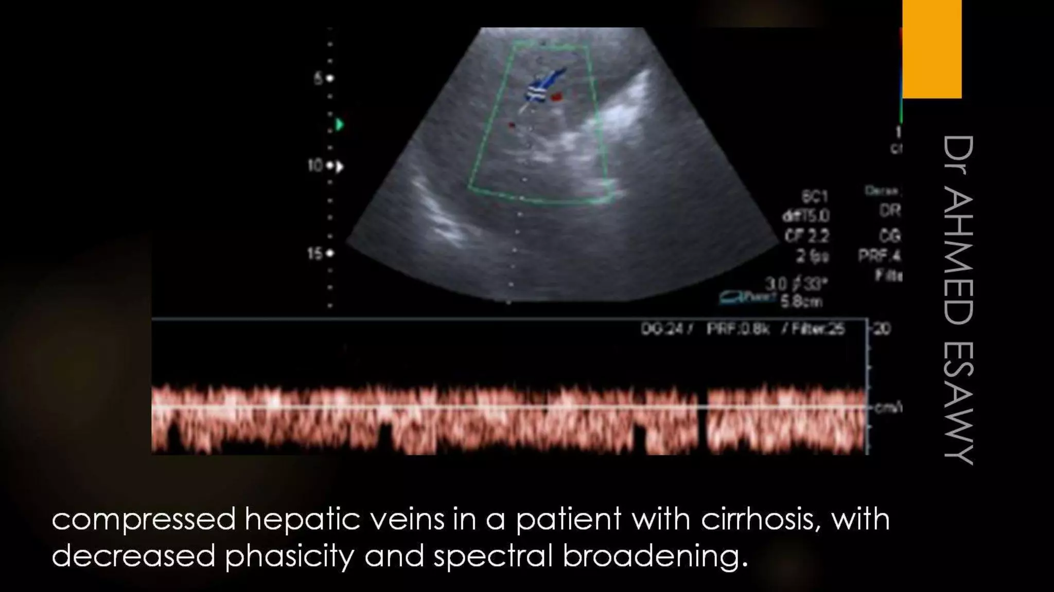 Ultrasound diffuse liver disease all things fibrosis,cirrhosis,us ...