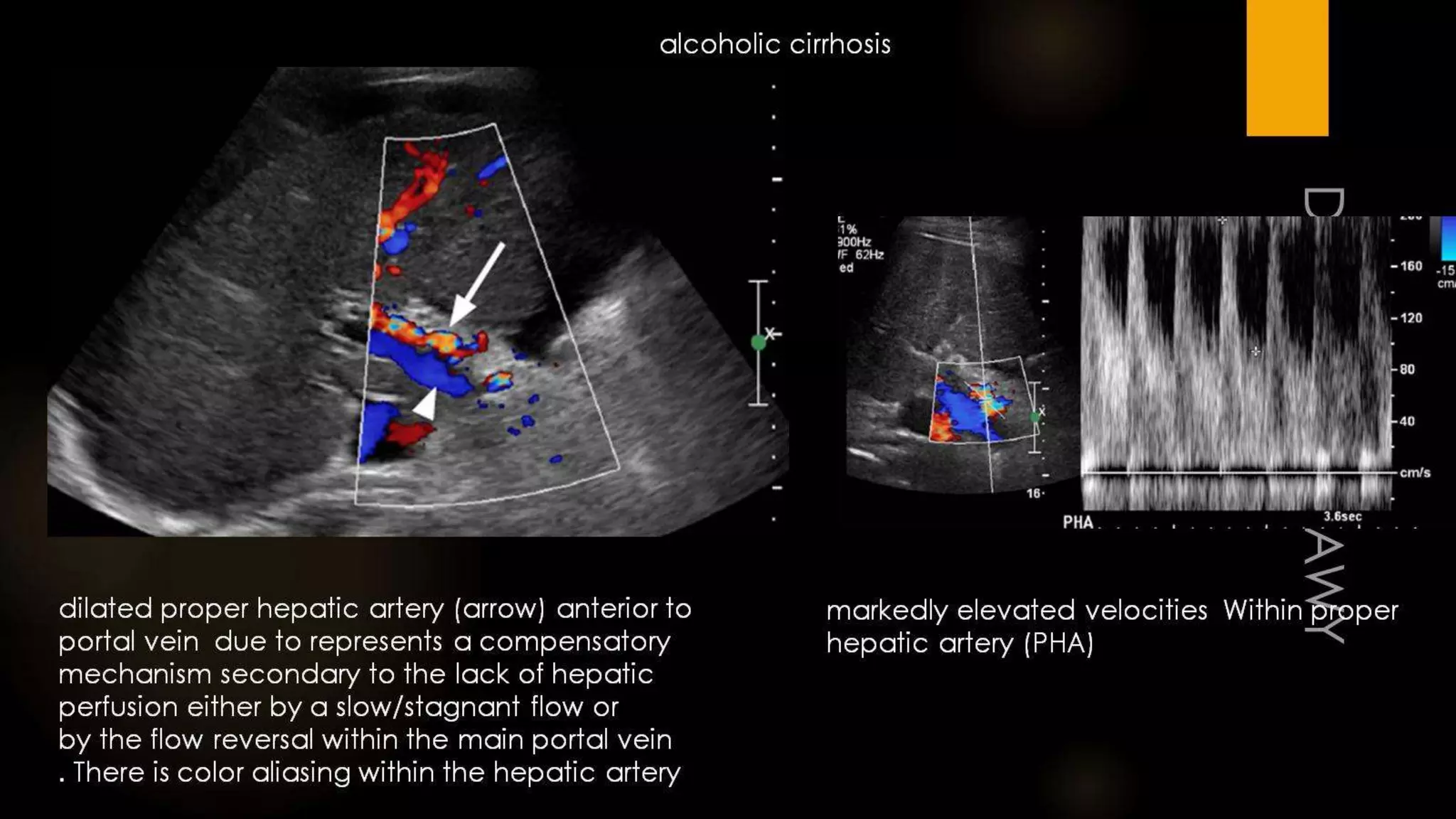 Ultrasound diffuse liver disease all things fibrosis,cirrhosis,us ...