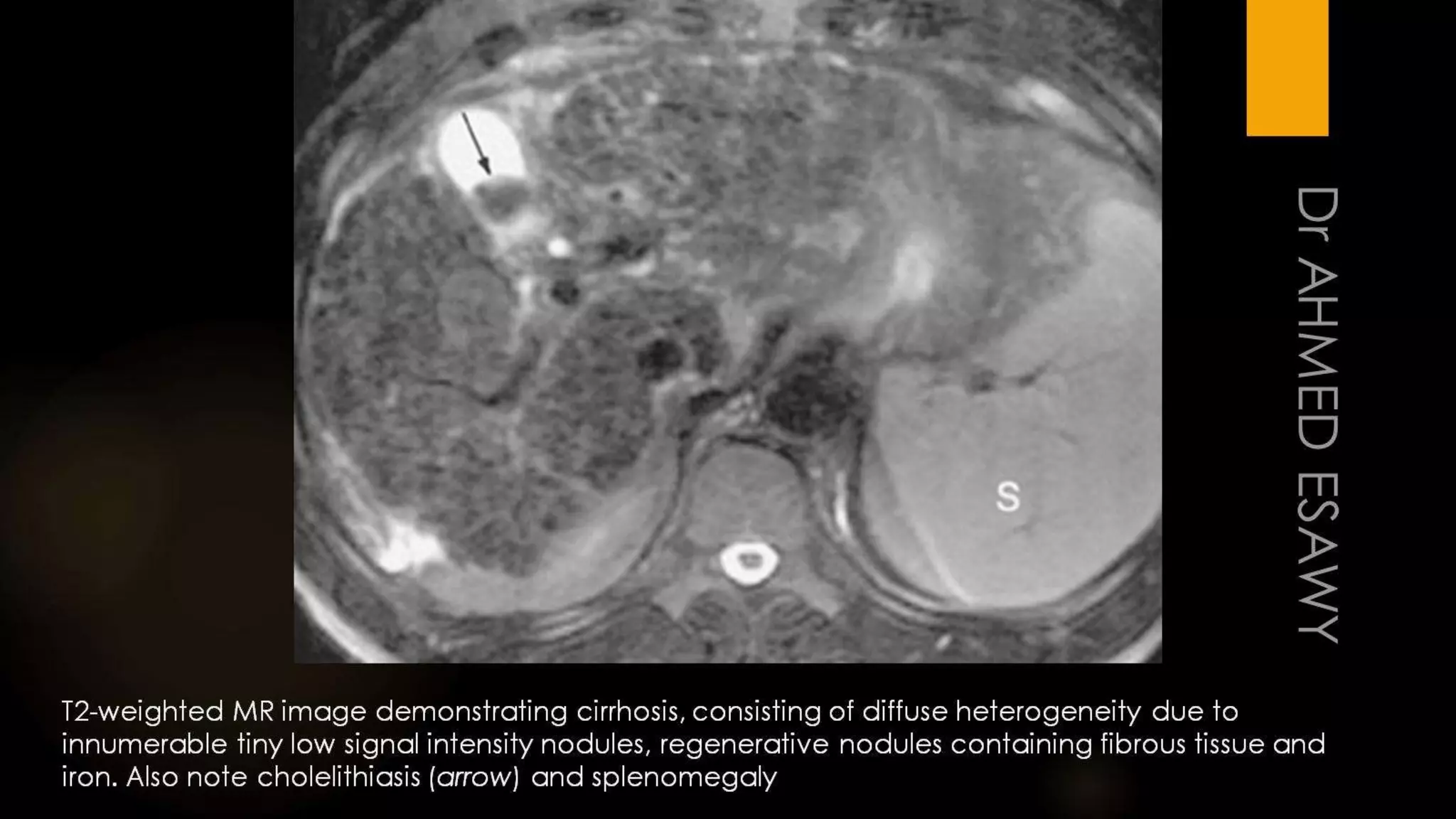Ultrasound diffuse liver disease all things fibrosis,cirrhosis,us ...