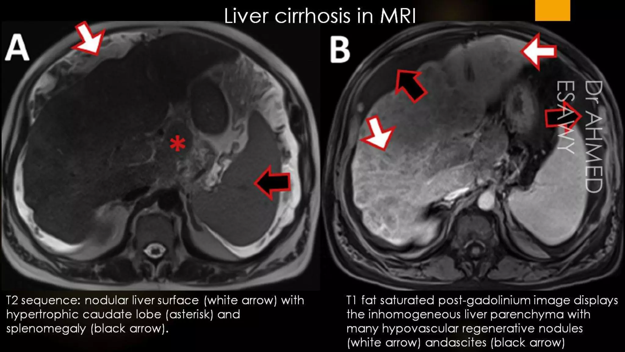 Ultrasound diffuse liver disease all things fibrosis,cirrhosis,us ...