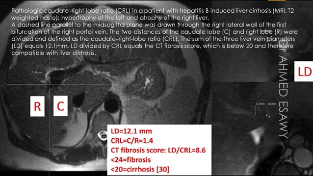Ultrasound diffuse liver disease all things fibrosis,cirrhosis,us ...