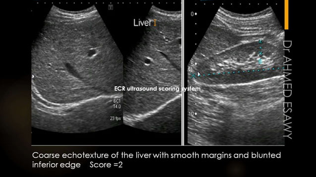 Ultrasound diffuse liver disease all things fibrosis,cirrhosis,us ...