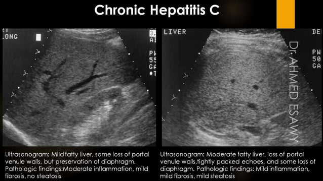 Ultrasound diffuse liver disease all things fibrosis,cirrhosis,us scoring,ce lrad,fibroscan ...