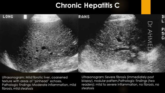 Ultrasound diffuse liver disease all things fibrosis,cirrhosis,us ...
