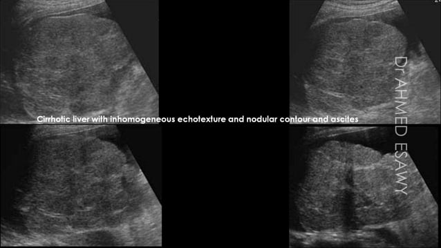 Ultrasound diffuse liver disease all things fibrosis,cirrhosis,us ...