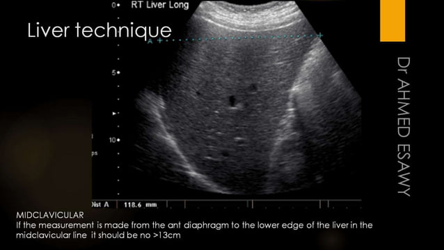 Ultrasound diffuse liver disease all things fibrosis,cirrhosis,us ...