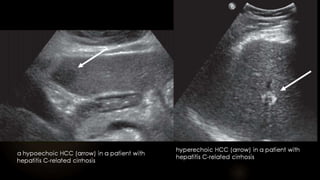 Ultrasound diffuse liver disease all things fibrosis,cirrhosis,us ...