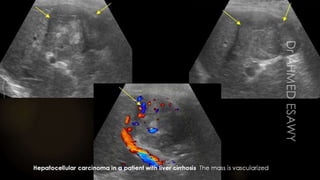 Ultrasound diffuse liver disease all things fibrosis,cirrhosis,us ...