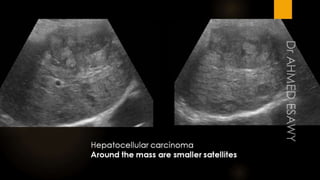 Ultrasound diffuse liver disease all things fibrosis,cirrhosis,us ...