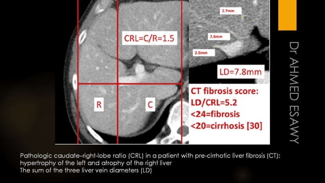 Ultrasound diffuse liver disease all things fibrosis,cirrhosis,us ...