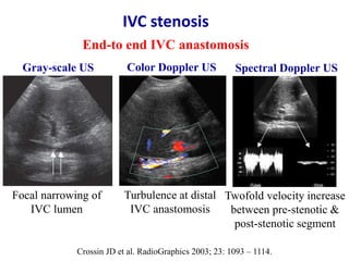 Ultrasound & doppler ultrasound in liver transplantation | PPTX
