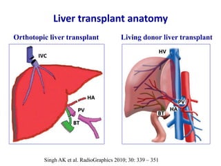 Liver Transplant Diagram