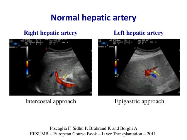 Ultrasound & doppler ultrasound in liver transplantation
