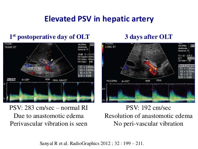 Ultrasound & doppler ultrasound in liver transplantation