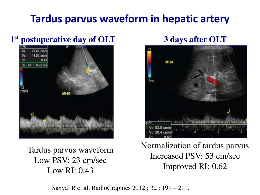 Ultrasound And Doppler Ultrasound In Liver Transplantation