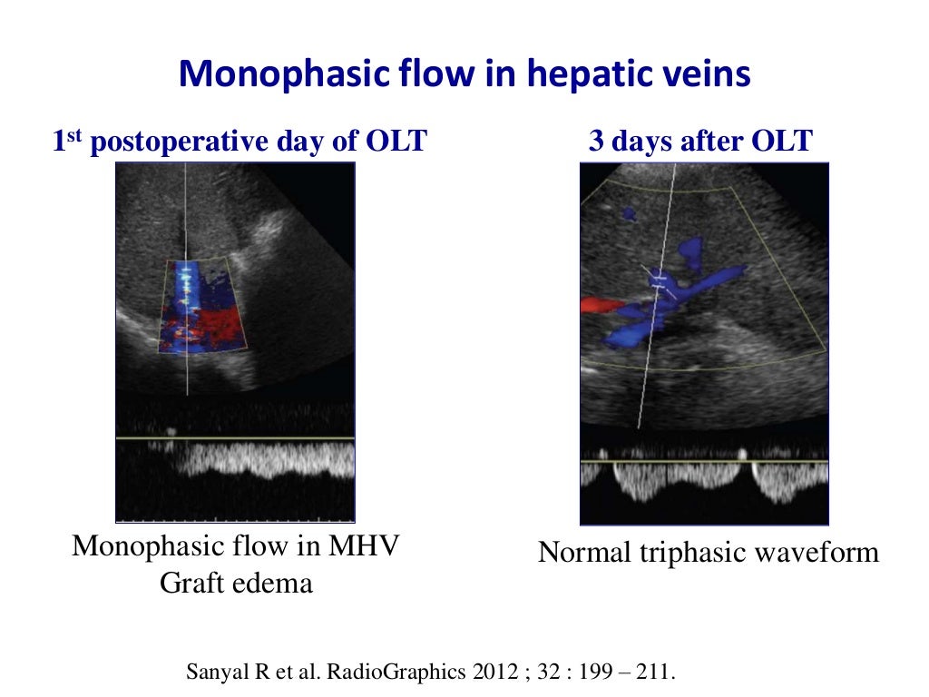 Ultrasound And Doppler Ultrasound In Liver Transplantation