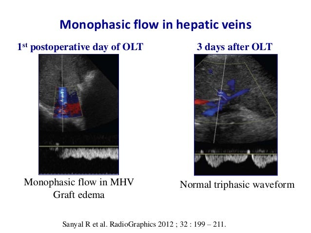 Ultrasound & doppler ultrasound in liver transplantation