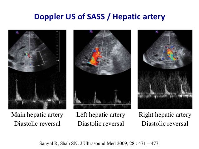 Hepatic Artery Ultrasound