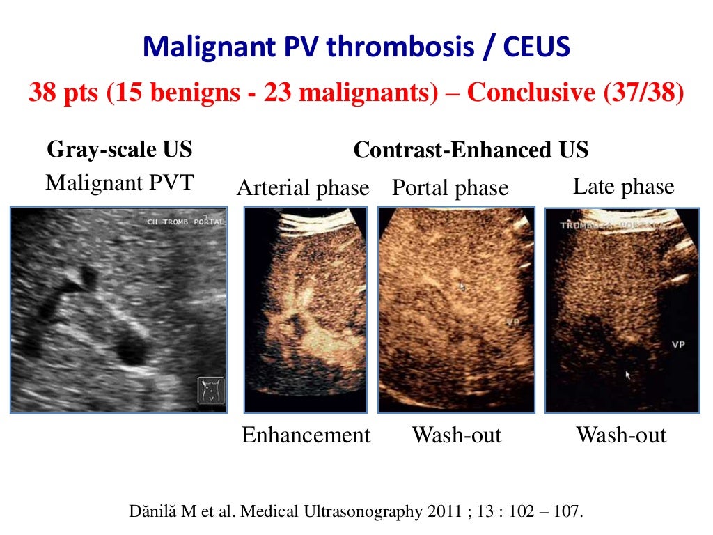 Ultrasound And Doppler Ultrasound In Liver Transplantation